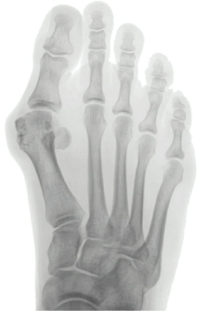 Hallux valgus - Behandlung und Operation - Orthopädie Zentrum ...