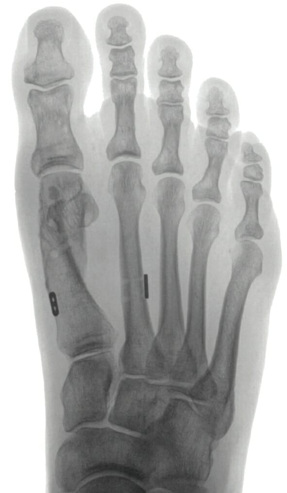 Hallux valgus - Behandlung und Operation - Orthopädie Zentrum ...