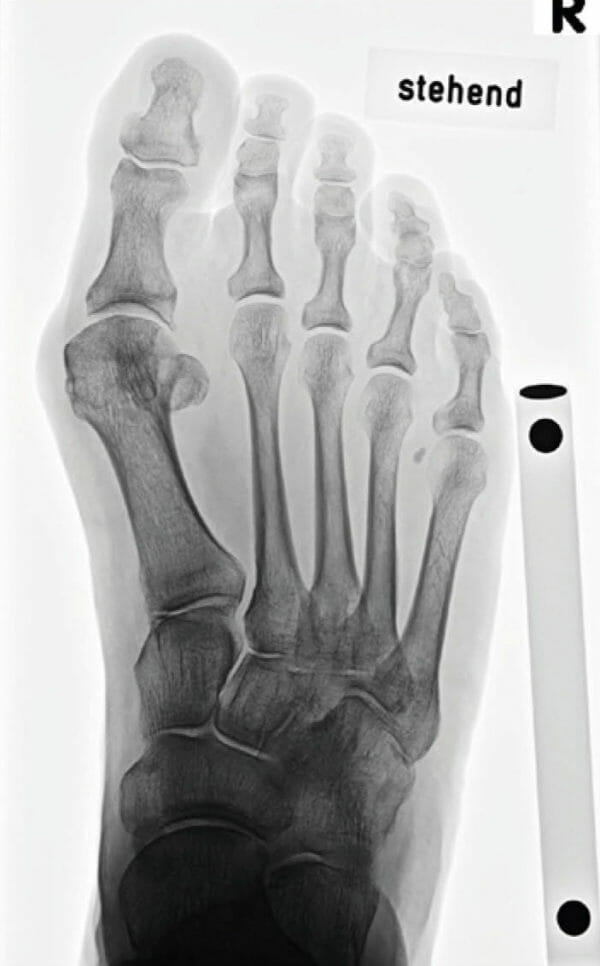 Hallux valgus - Orthopädie Zentrum Arabellapark München